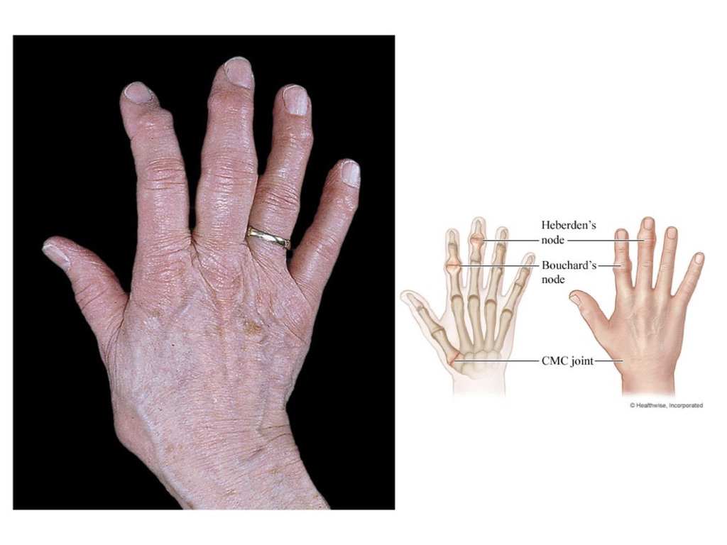 8 Fatores de Risco para Ter Artrose no Joelho. – FÊMUR DISTAL